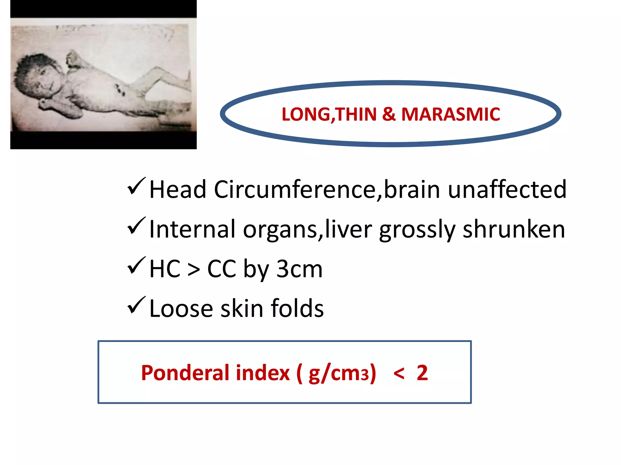 SMALL FOR GESTATIONAL AGE,LARGE FOR GESTATIONAL AGE -SSJ, CALICUT ...