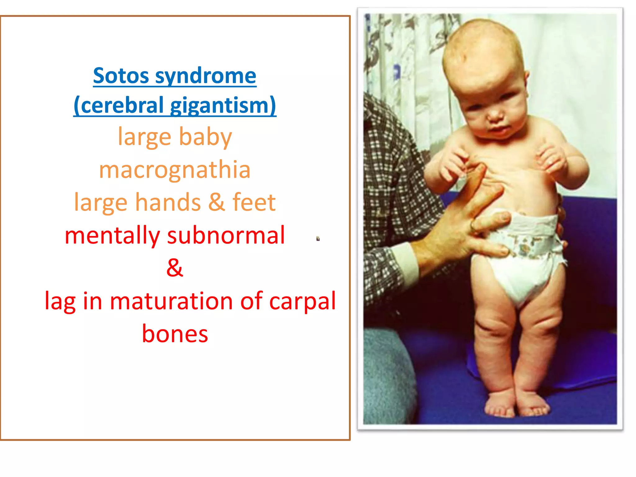 SMALL FOR GESTATIONAL AGE,LARGE FOR GESTATIONAL AGE -SSJ, CALICUT ...