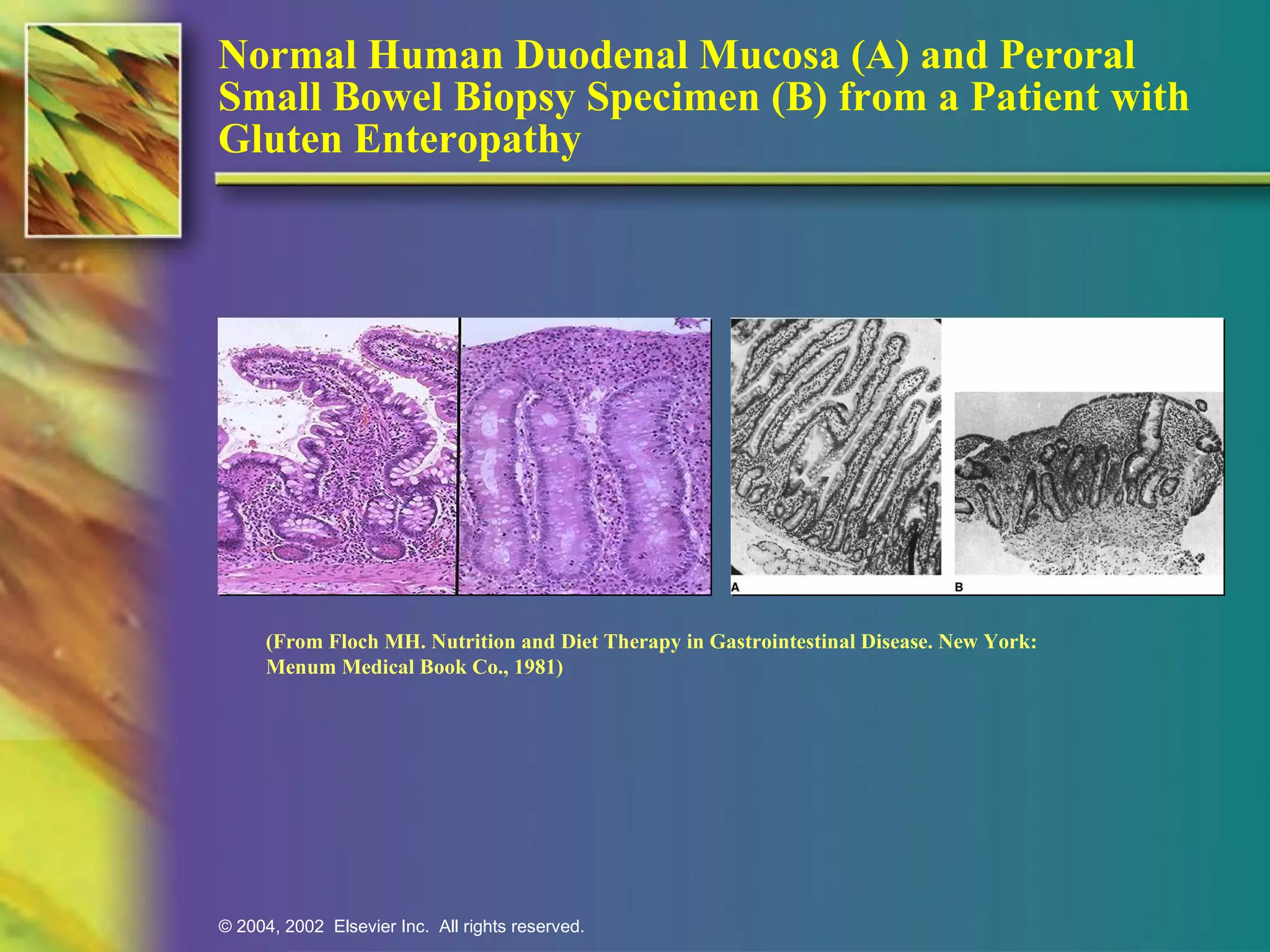celiac disease | PPT