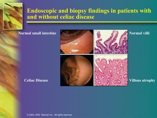 celiac disease | PPT