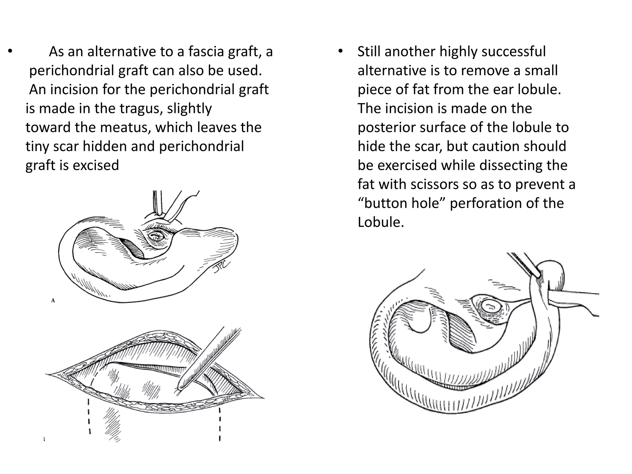 Myringoplasty ppt | PPTX