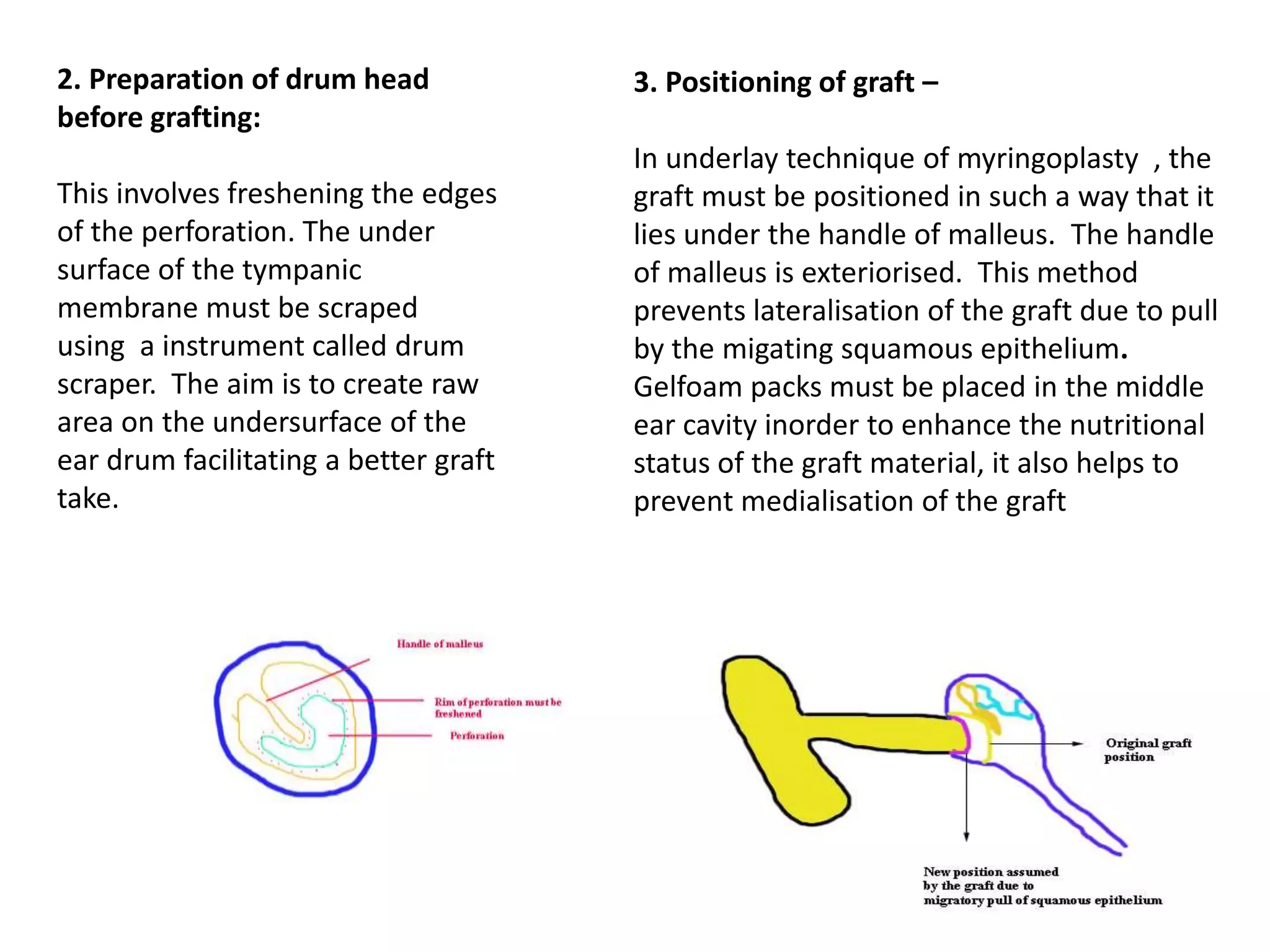 Myringoplasty ppt | PPTX