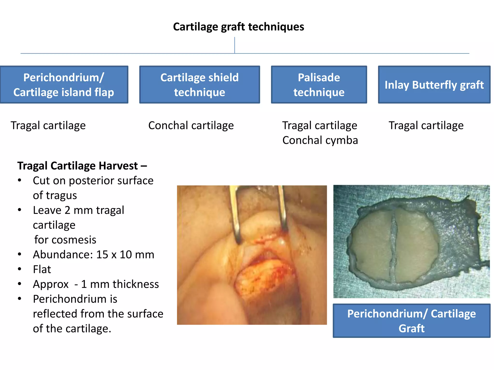 Myringoplasty ppt | PPTX