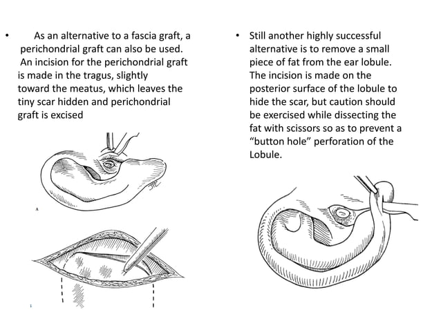 Myringoplasty ppt | PPT