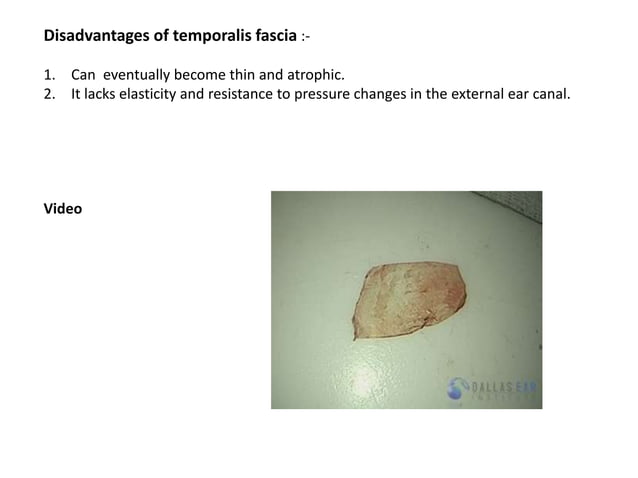 Myringoplasty ppt | PPTX