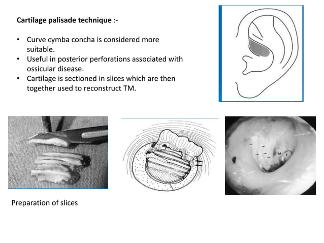 Myringoplasty ppt | PPTX