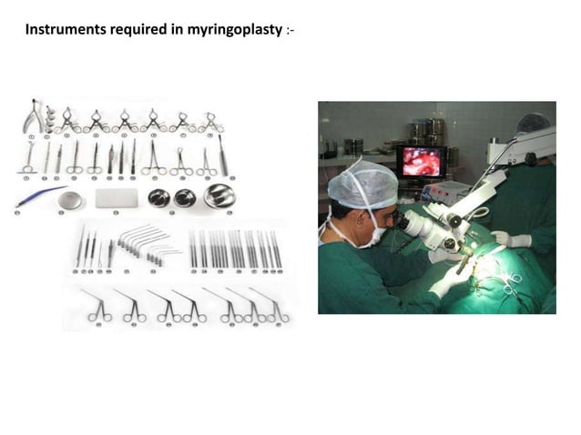 Myringoplasty ppt | PPTX