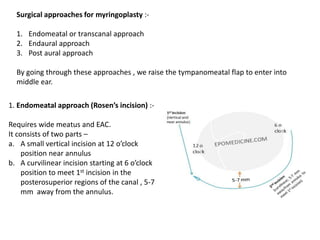 Myringoplasty ppt | PPTX
