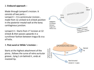 Myringoplasty ppt | PPTX