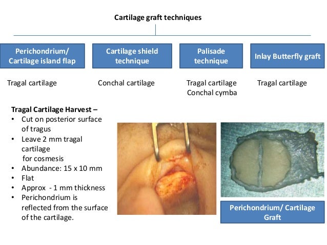 Myringoplasty ppt