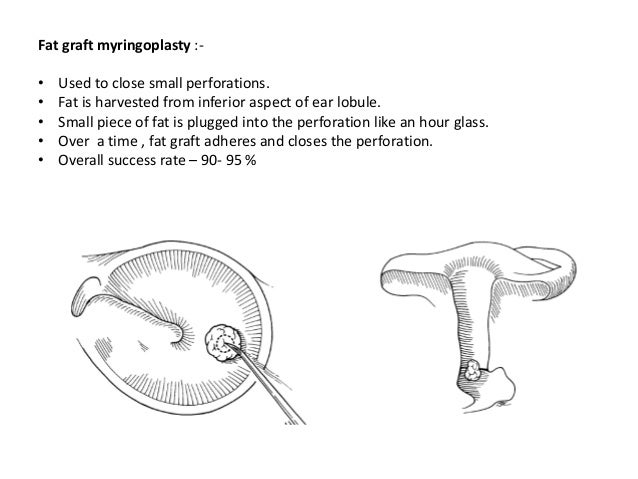 Myringoplasty ppt