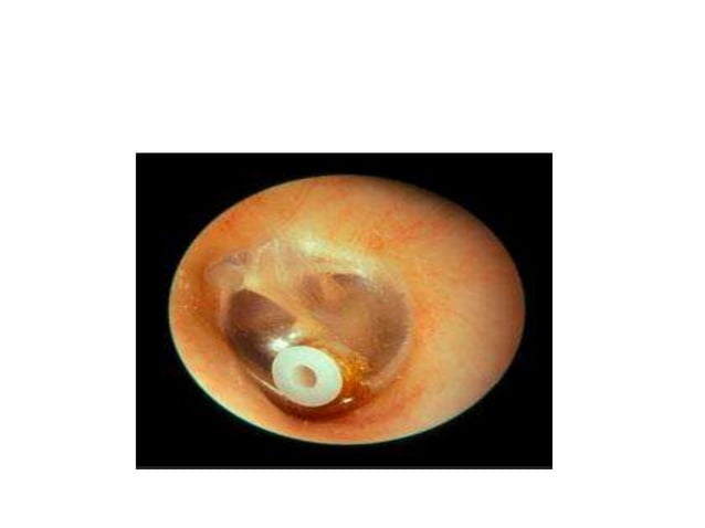 Myringotomy and grommet insertion | PPTX