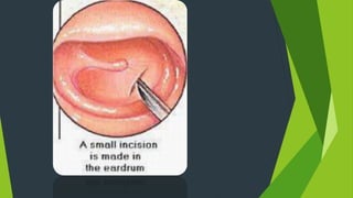 Myringotomy Final.pptx