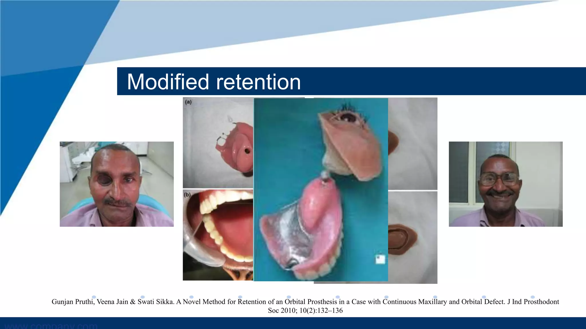 Eye Prosthesis | PPTX