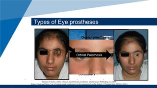 Eye Prosthesis | PPTX