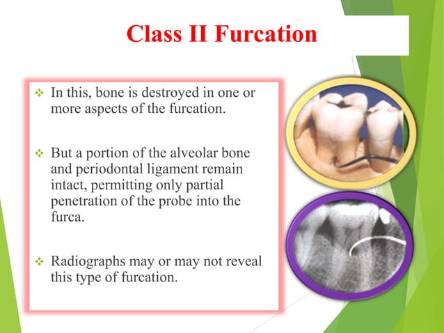Furcation | PPTX | Dental Health | Diseases and Conditions