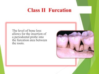 Furcation | PPTX