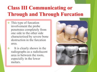 Furcation | PPTX