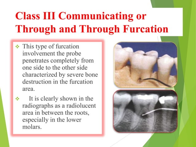 Furcation | PPTX | Dental Health | Diseases and Conditions