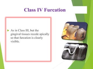 Furcation | PPTX