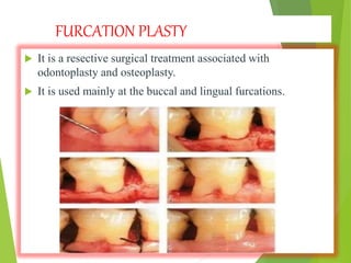 Furcation | PPTX