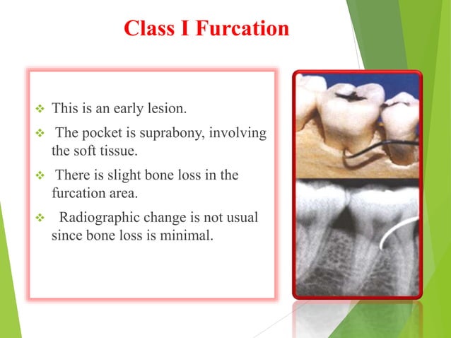 Furcation | PPTX | Dental Health | Diseases and Conditions
