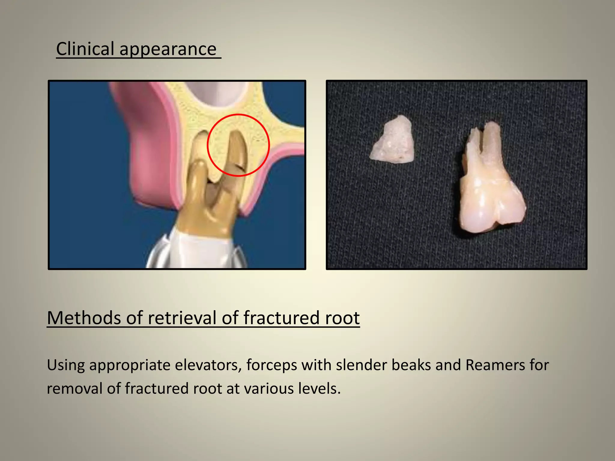 Complications of EXODONTIA | PPTX