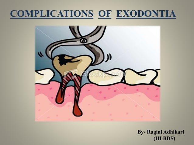 Complications of EXODONTIA | PPTX | Dental Health | Diseases and Conditions