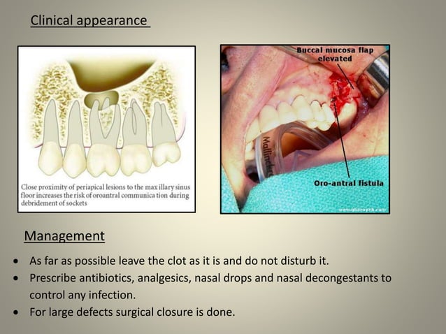 Complications of EXODONTIA | PPTX | Dental Health | Diseases and Conditions