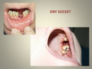 Complications of EXODONTIA | PPTX