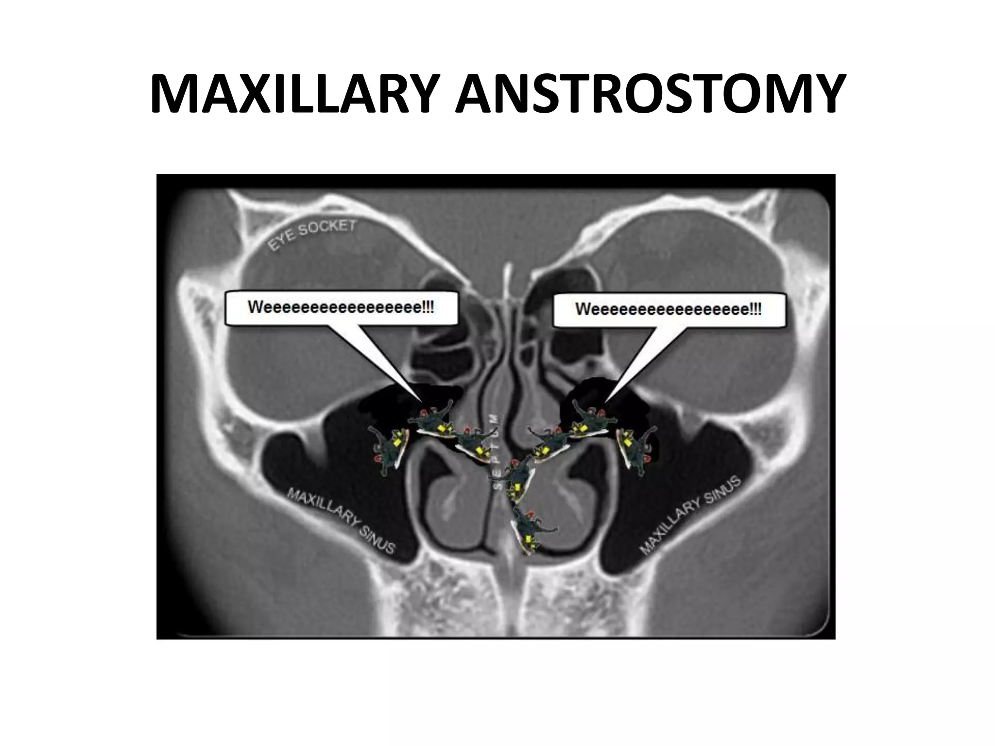 My sinus surgery | PPTX