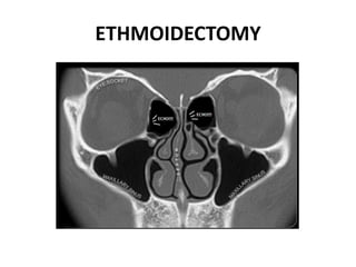 My sinus surgery | PPTX