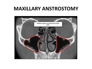 My sinus surgery | PPTX