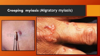 Myiasis ....a parasitic disease. | PPTX
