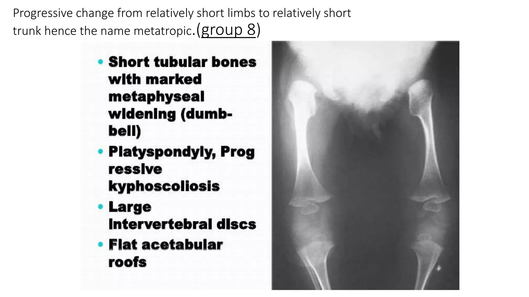 skeletal dysplasia ppt | PPTX