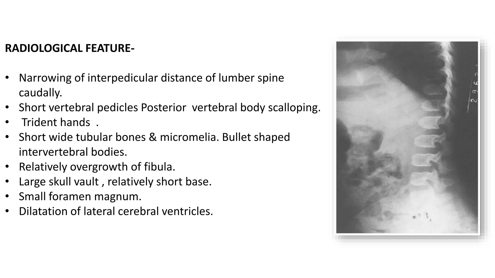 skeletal dysplasia ppt | PPTX