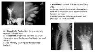 skeletal dysplasia ppt | PPTX