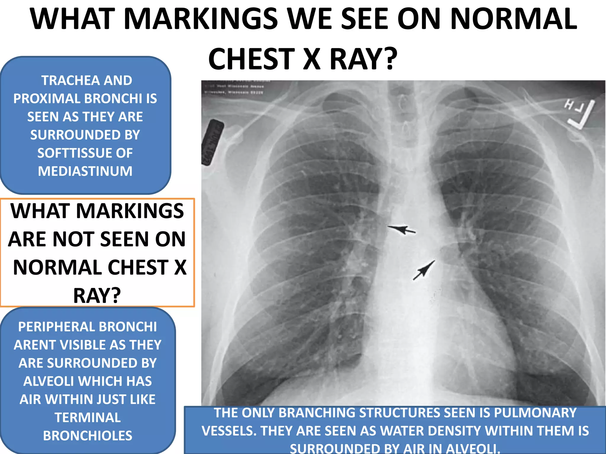 chest x ray alveolar diseases.pptx