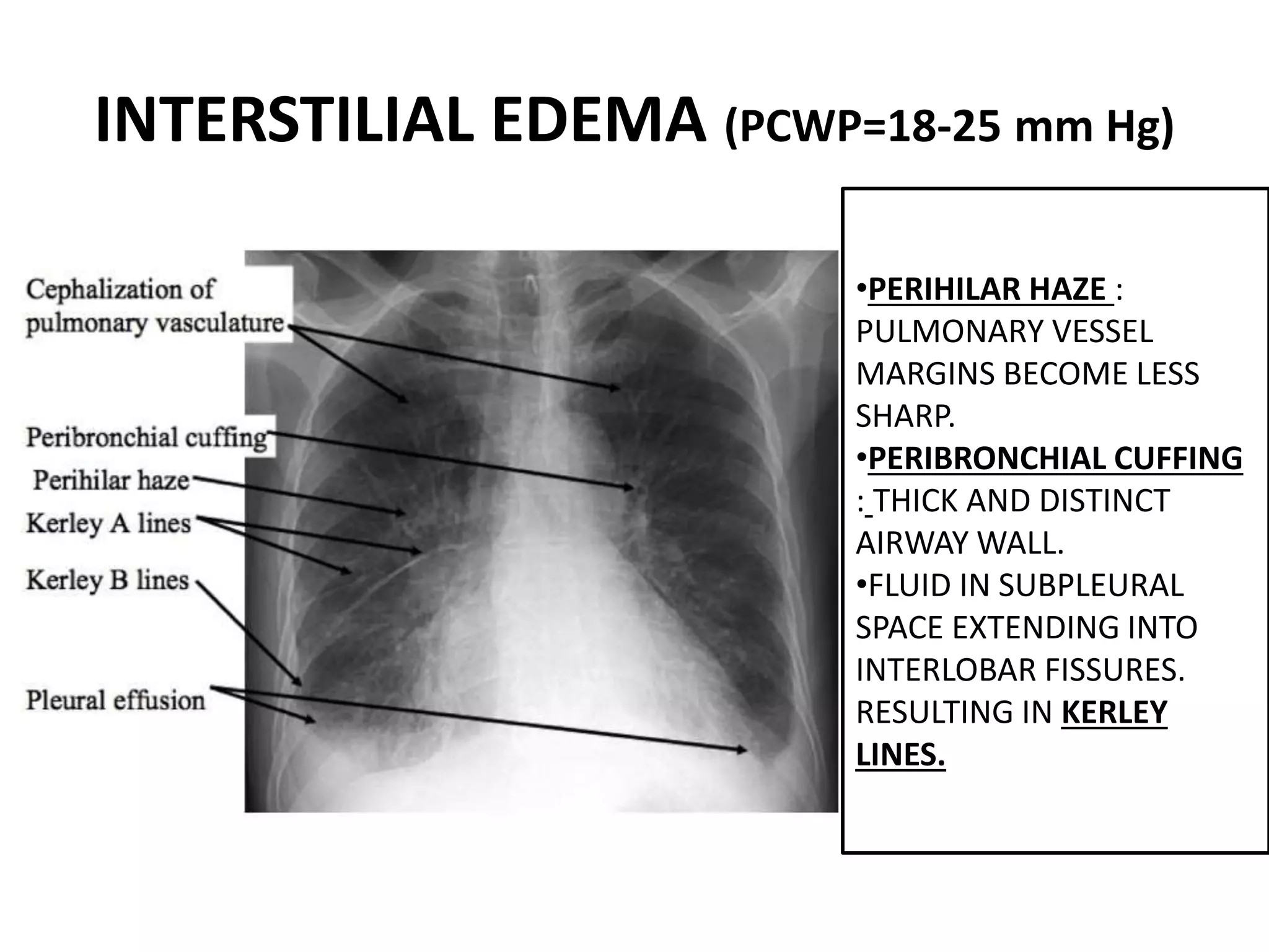 chest x ray alveolar diseases.pptx