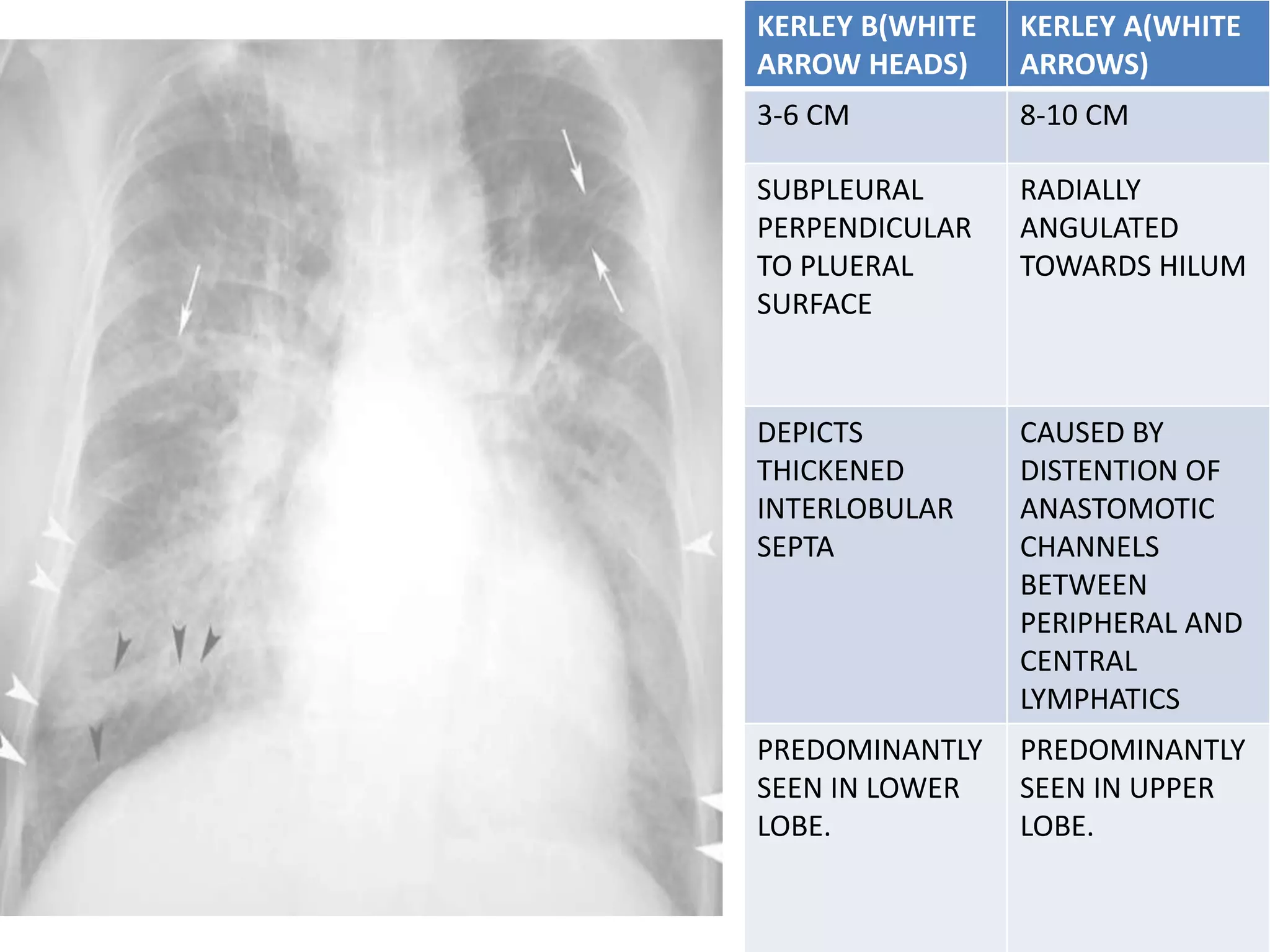 chest x ray alveolar diseases.pptx