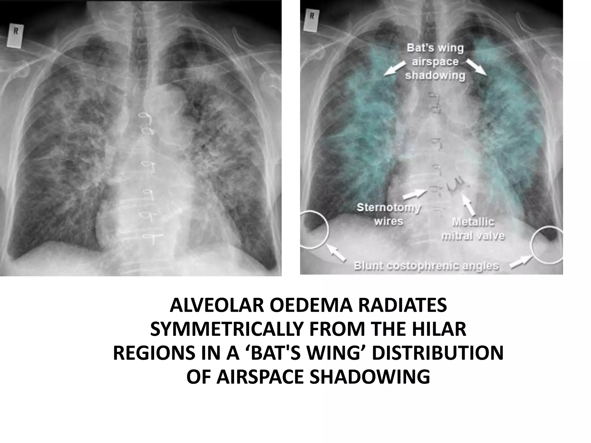 chest x ray alveolar diseases.pptx