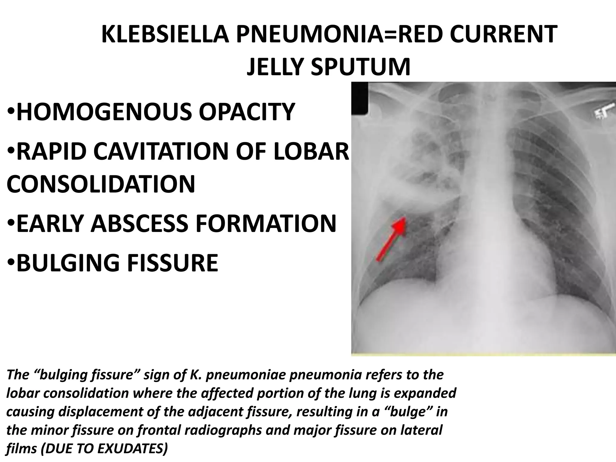 chest x ray alveolar diseases.pptx