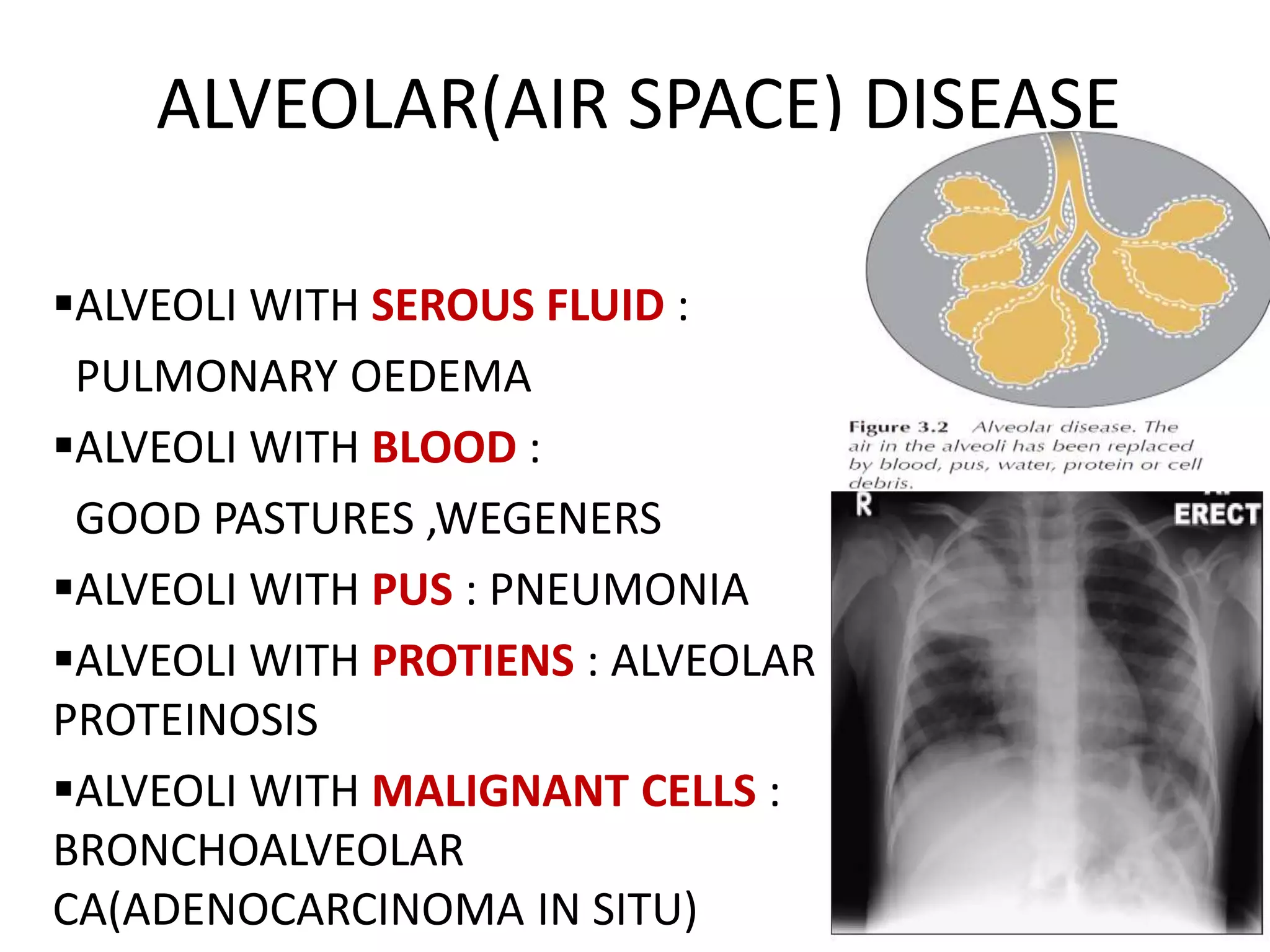 chest x ray alveolar diseases.pptx
