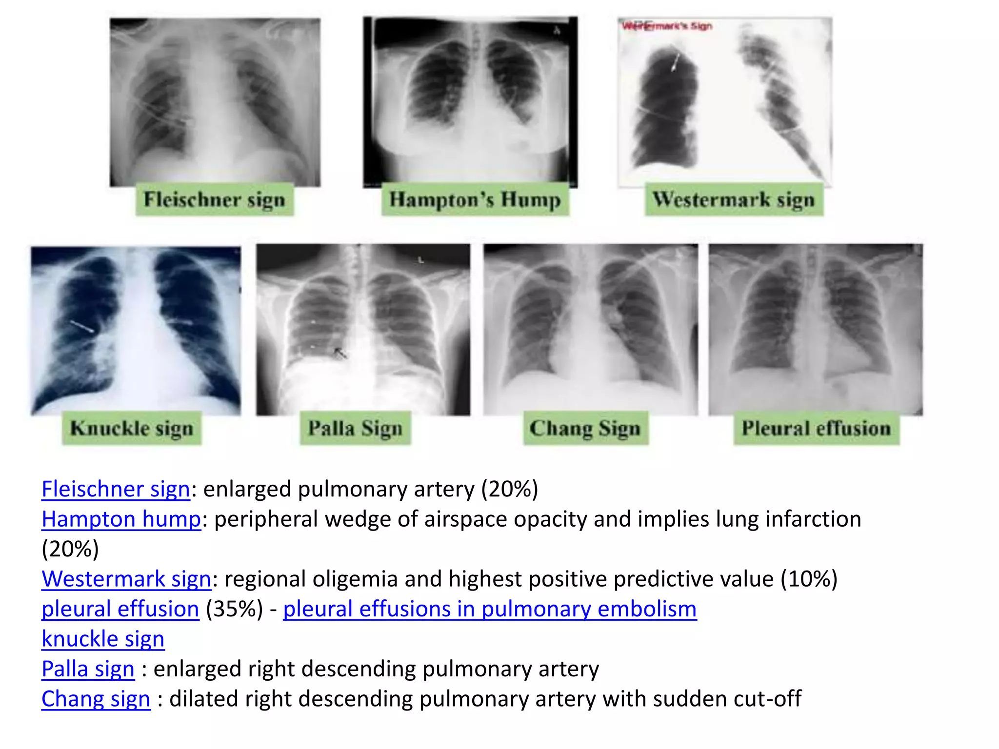 chest x ray alveolar diseases.pptx