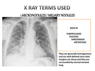 chest x ray alveolar diseases.pptx