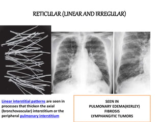 chest x ray alveolar diseases.pptx