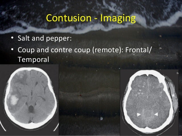 Surgery for Head Injury