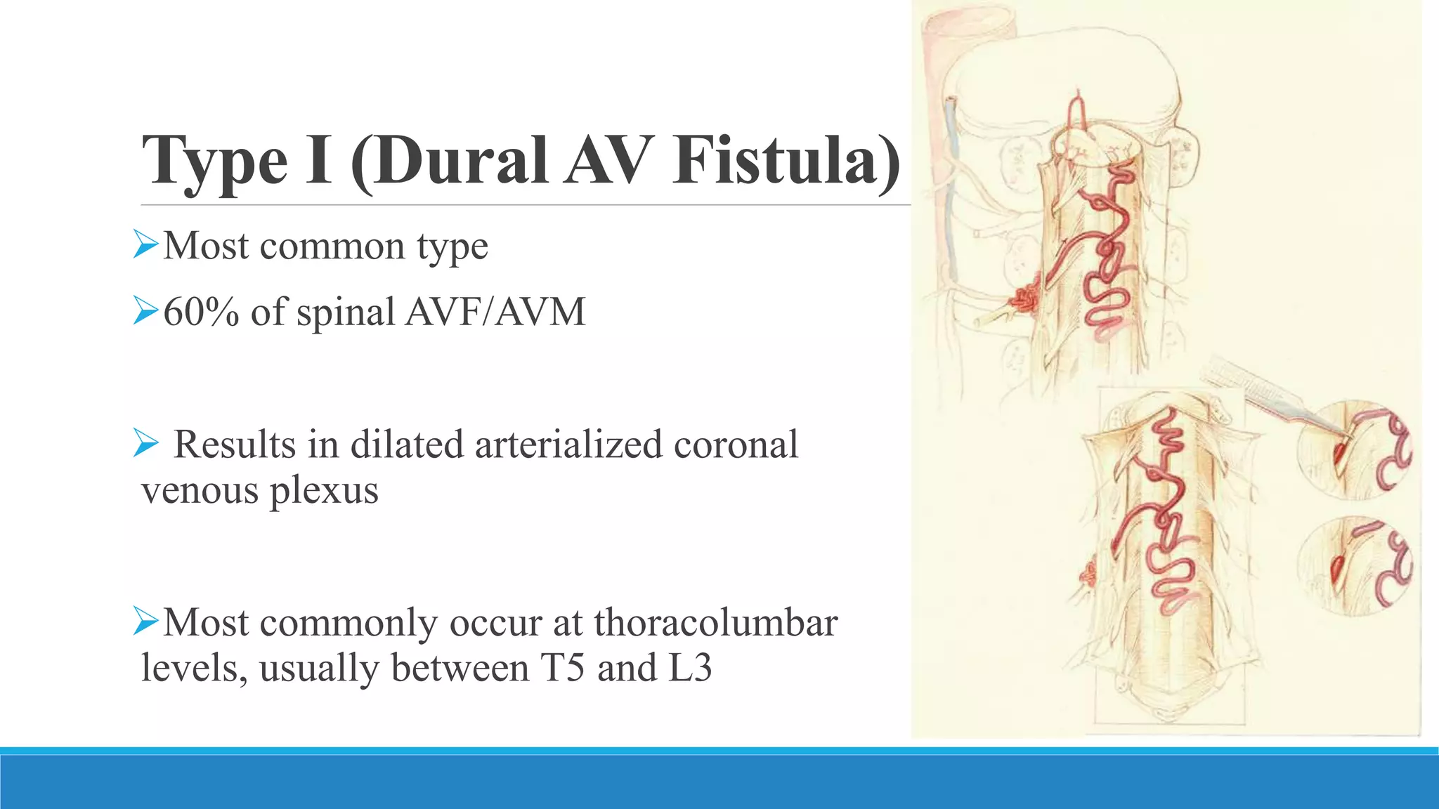 spinal angiography with spnal av anomalies | PPTX