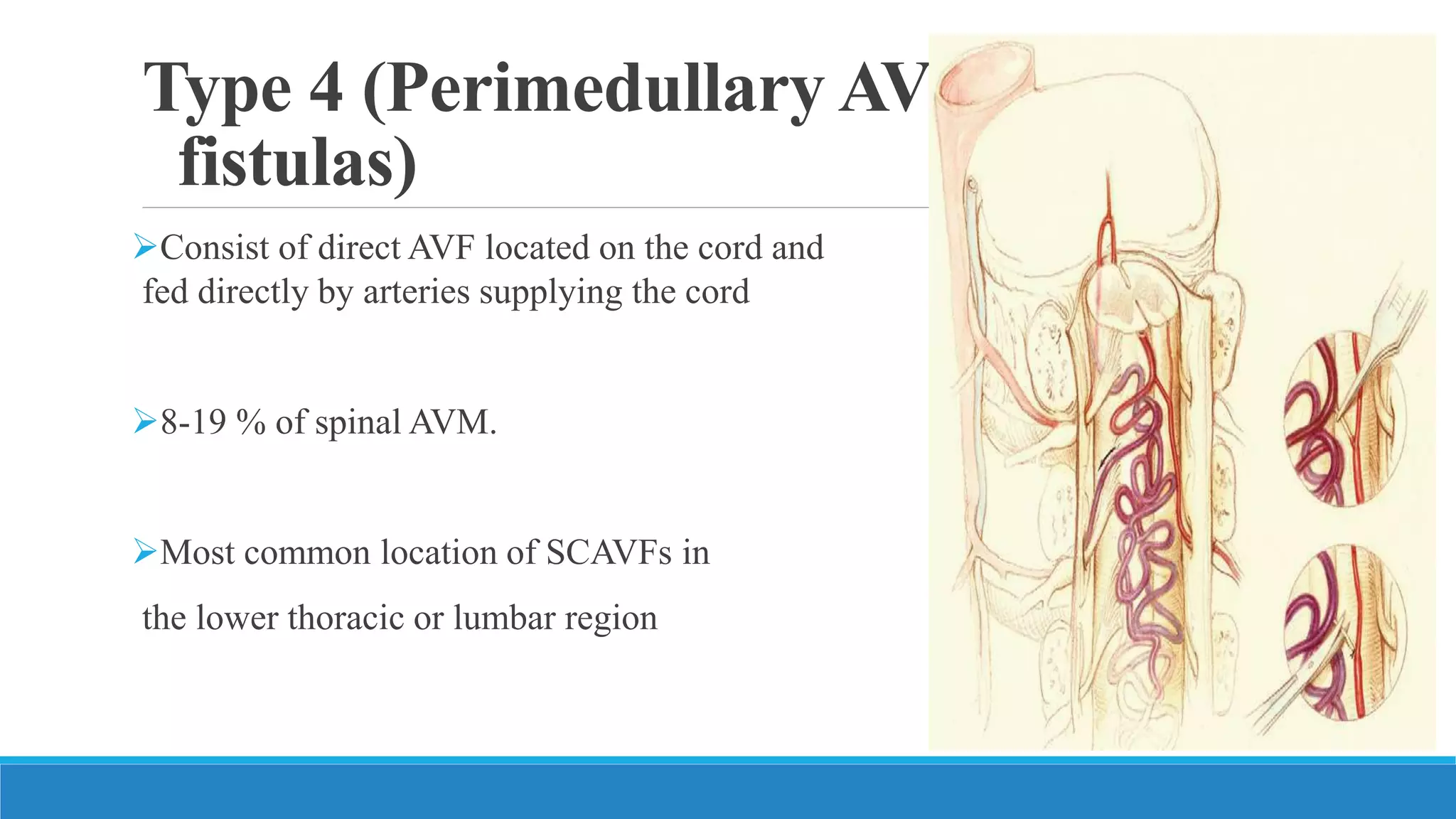 spinal angiography with spnal av anomalies | PPTX