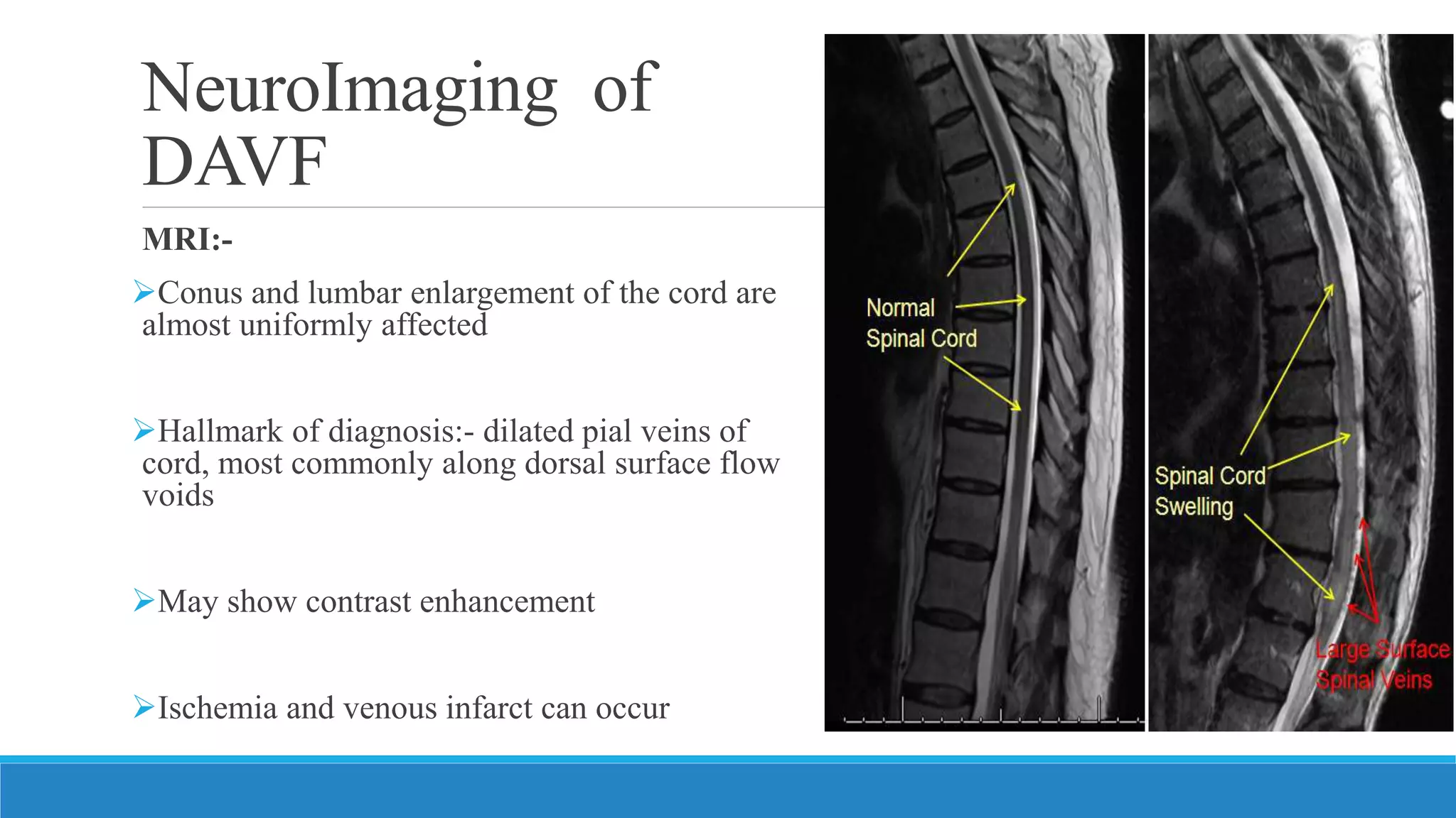 spinal angiography with spnal av anomalies | PPTX